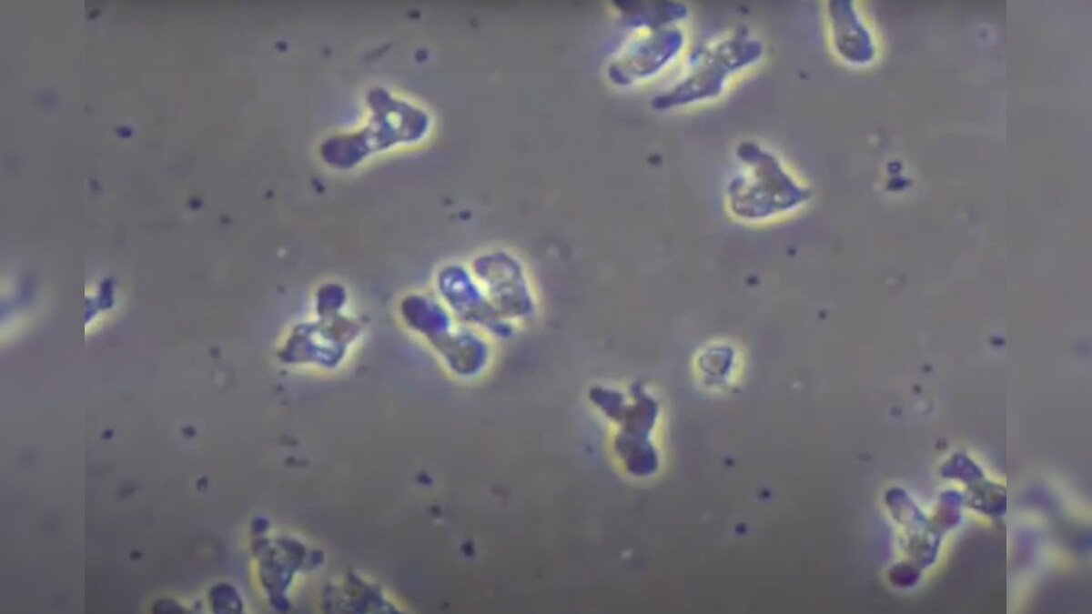 Rare Brain-Eating Amoeba Case Reported in the US, Here's What the ...