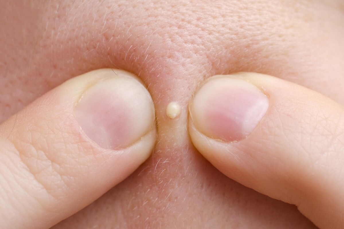 Chinese Man Almost Dies After Popping A Pimple Causes His Lungs To Collapse Chinese Man Almost Dies After Popping A Pimple Causes His Lungs To Collapse