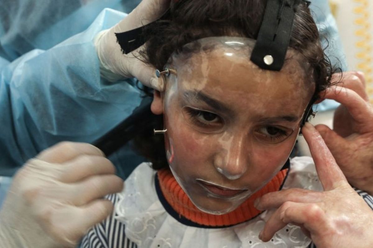 'I'm Afraid People Will Laugh': Gaza Girl Wears 3D Plastic Mask to Heal ...