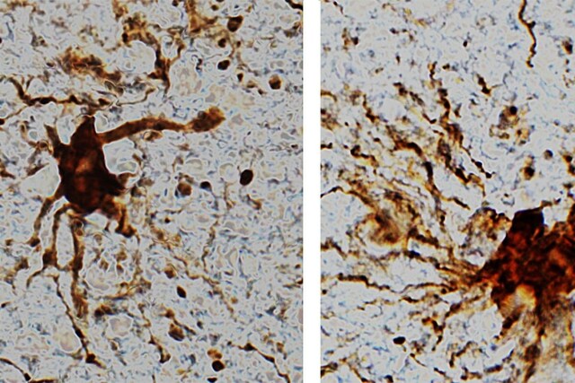 'Zombie Genes' in Humans Come Alive and Grow Long Arm-like Appendages ...