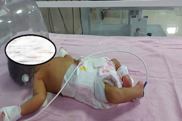 In Madhya Pradesh, Parents Abandon Rare Baby Born With Inverted Legs ...
