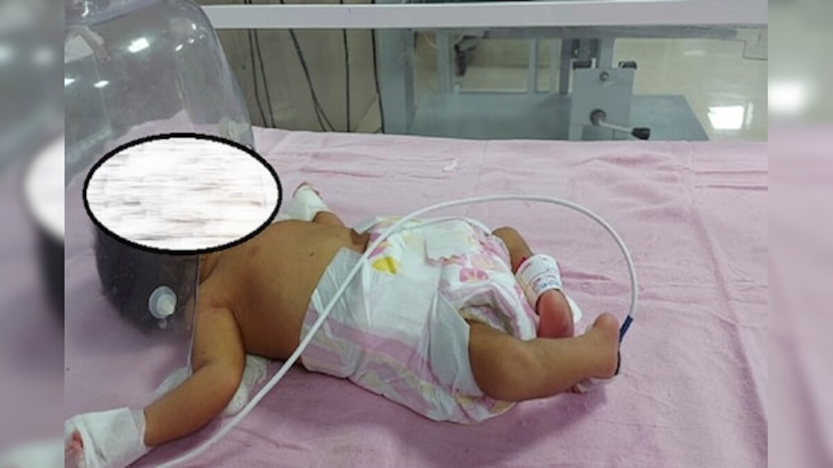 In Madhya Pradesh, Parents Abandon Rare Baby Born With Inverted Legs