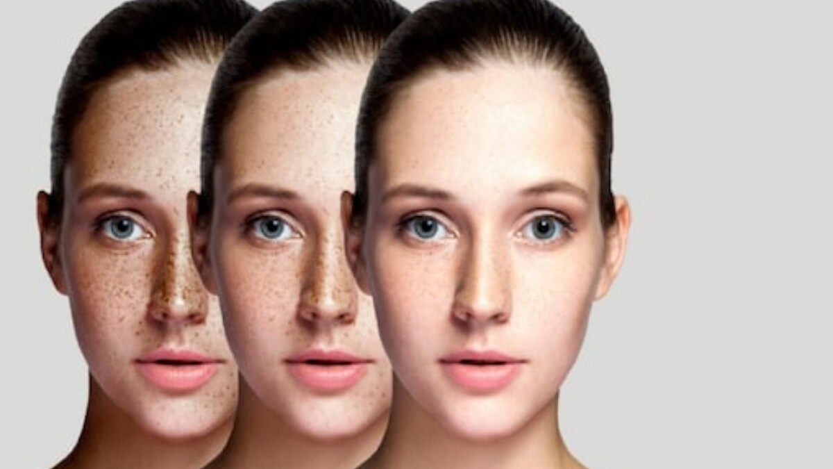 What Causes Dark Spots and Pigmentation on Face - News18
