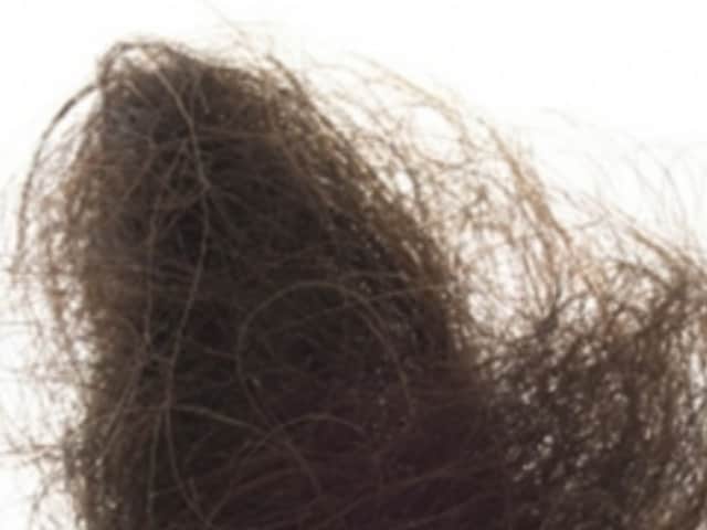 Up Doctors Remove 2 Kg Hairball From Stomach Of Girl Who Has Rapunzels
