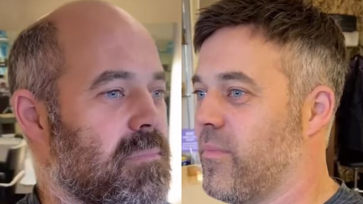 Bald Man Undergoes Hair Transformation, Netizens Say He Looks '10 Years ...