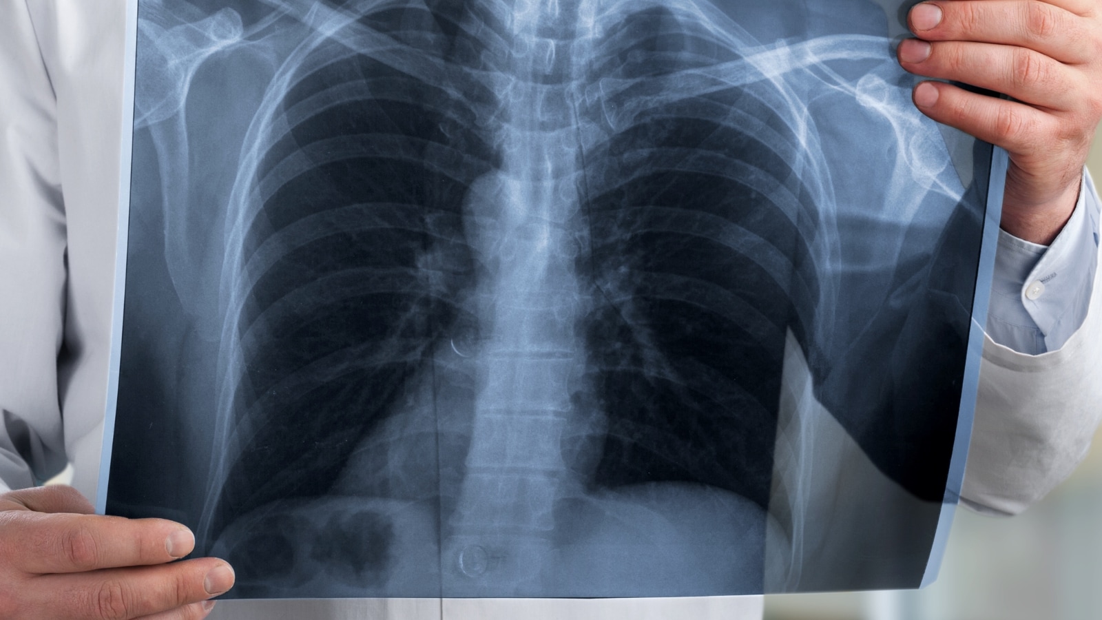 80-year-old Woman Claims Cannabis Oil Helped 'Cure' Her Lung Cancer ...