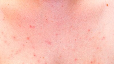 What leads to Breast Acne? Check Out the 8 Most Prominent Factors ...