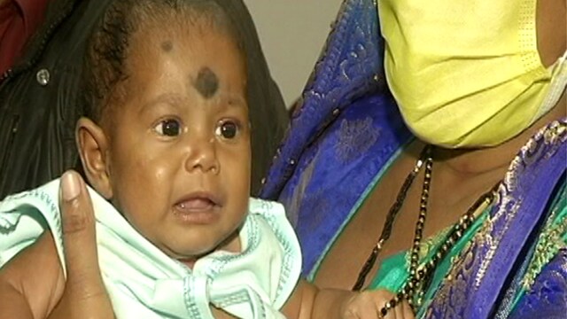 Odisha Newborn's 'True Human Tail' Surgically Removed in World's First ...