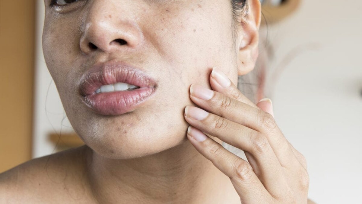 Endometriosis Acne: What is it and How to Keep it Under Control - News18