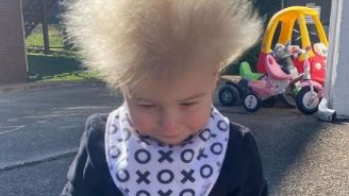 This US Toddler Has Uncombable Hair Syndrome, a Rare Genetic Condition ...