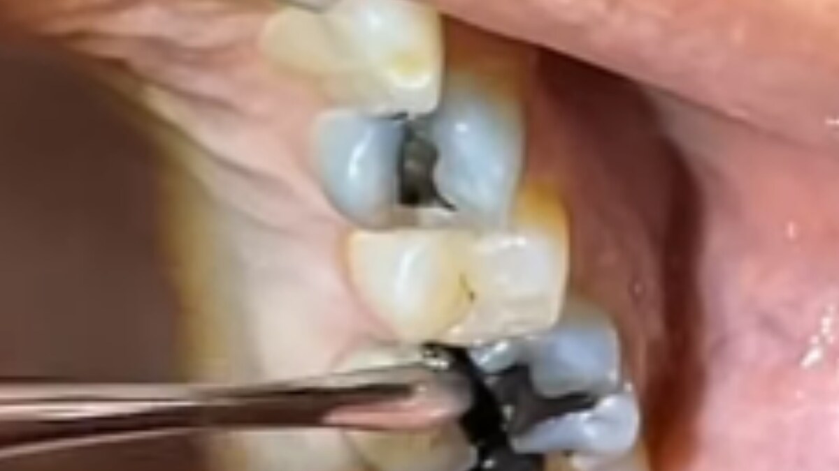 Does Chewing on Ice Damage Your Teeth? Dentist's Graphic Video Has No ...