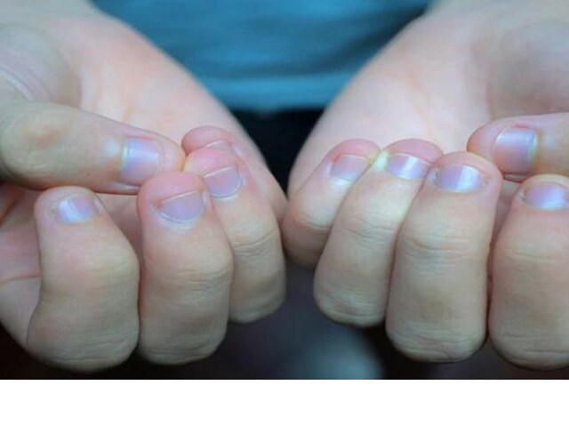 Skincare Tips: Get Rid of Peeling Cuticles With These Easy Home ...