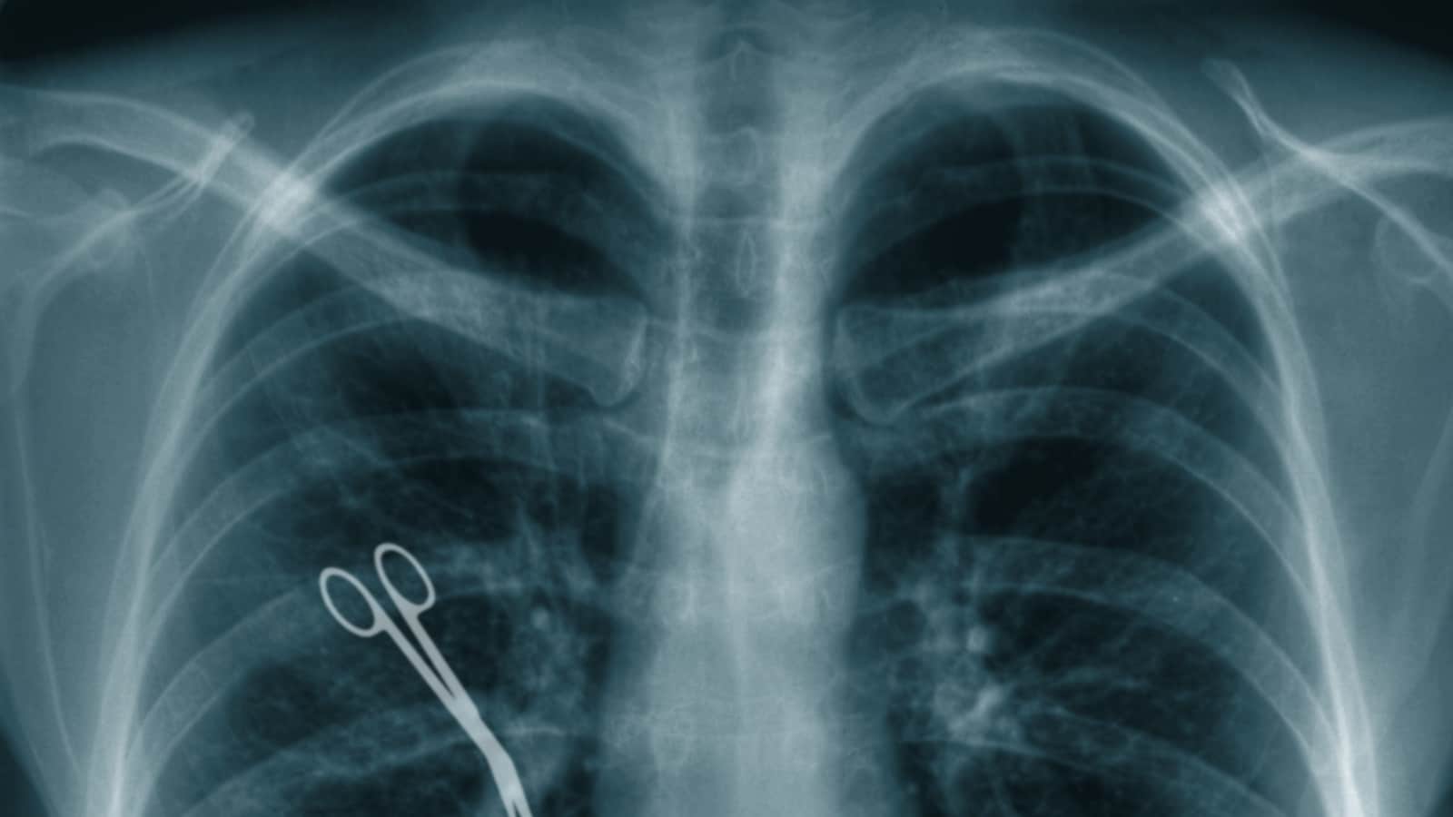 Venezuelan Patient Dies Days After Surgeons Forget Scissors Inside His ...