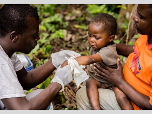 Is Monkeypox Severe In Children? Here is What Parents Should Know - News18