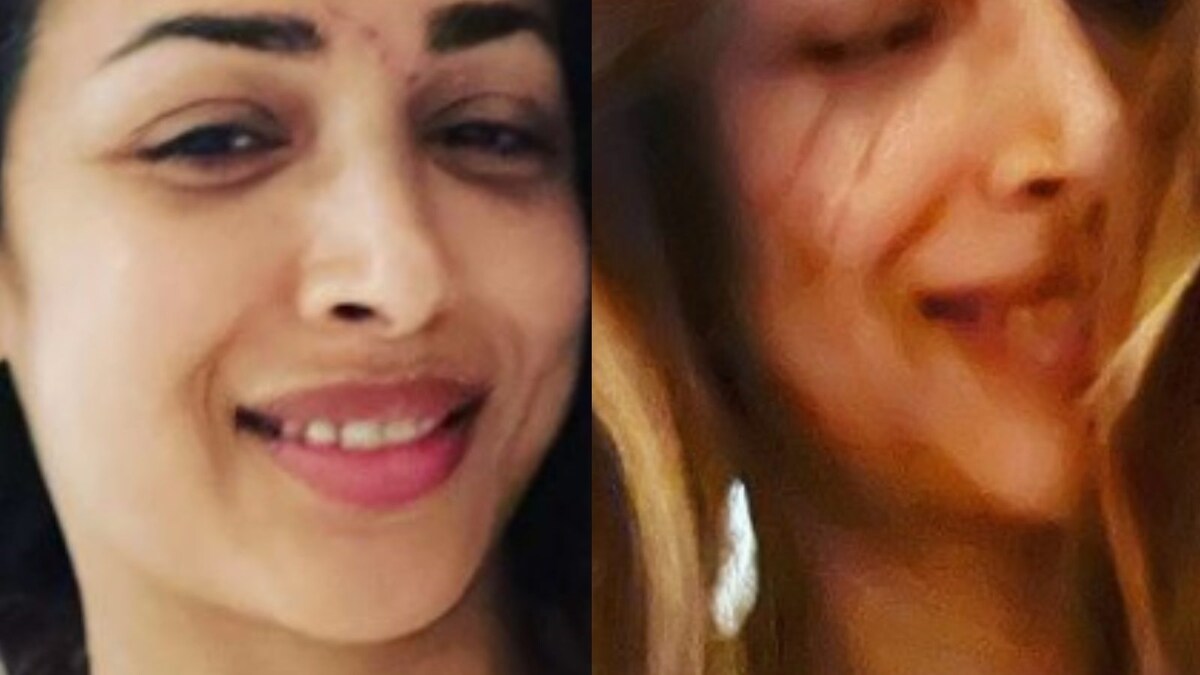 Malaika Arora Doesn’t Hide Scar as She Spends A ‘Silly, Goofy, Lazy ...