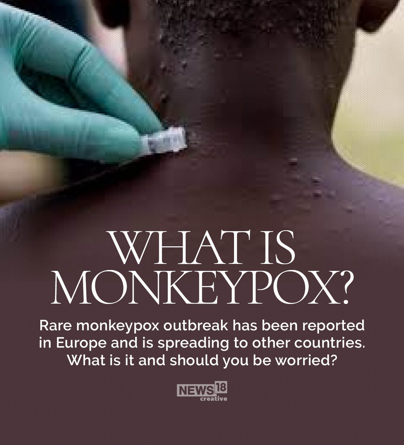 As Monkeypox Detected in North America, Europe; Here's All You Need to ...