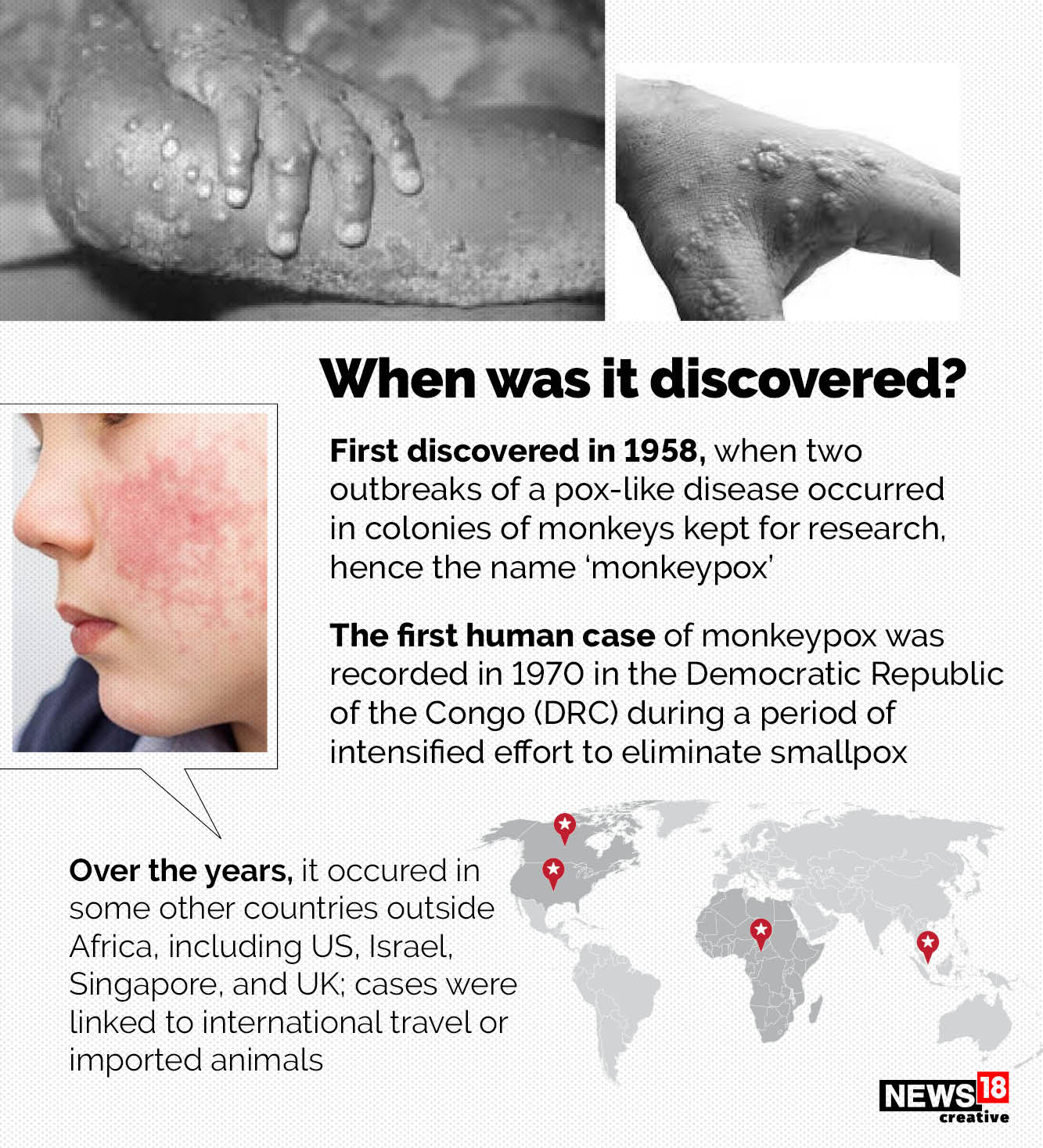 As Monkeypox Detected in North America, Europe; Here's All You Need to ...