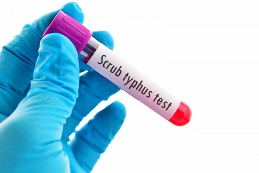 Kerala Reports Second Death Due to Scrub Typhus. All About the Disease ...