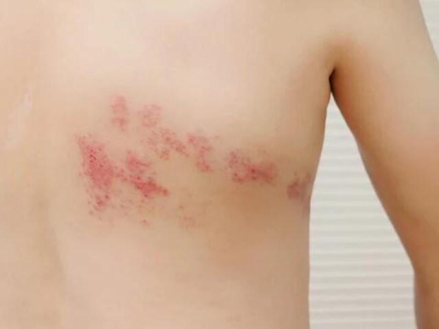 Follow These Home Remedies For Prevention Of Shingles - News18