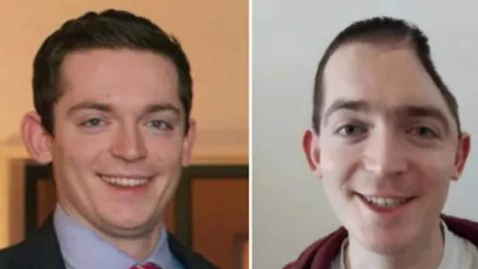 Man Who Lost Half His Skull During An Office Party Sues Firm | Buzz ...