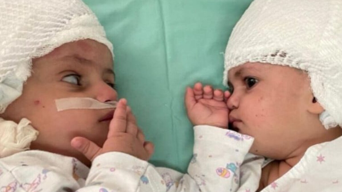 Brazilian Mother Gives Birth to Twins With Different Biological Fathers ...