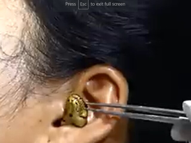 WATCH: Spooky Footage of Snake Stuck Inside Woman's Ear Shocks The ...