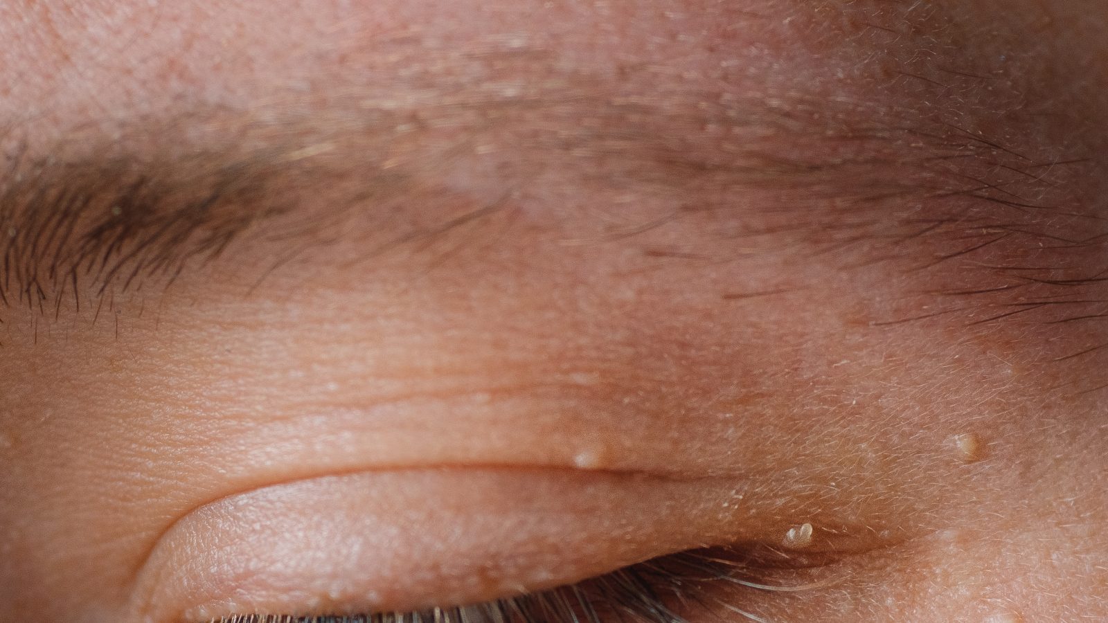 White Bumps On Skin