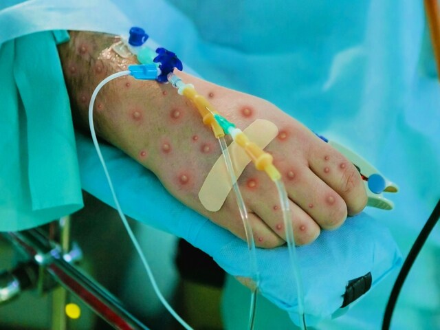 Paediatric Monkeypox Cases Rising in the US as More Than 30 Children ...