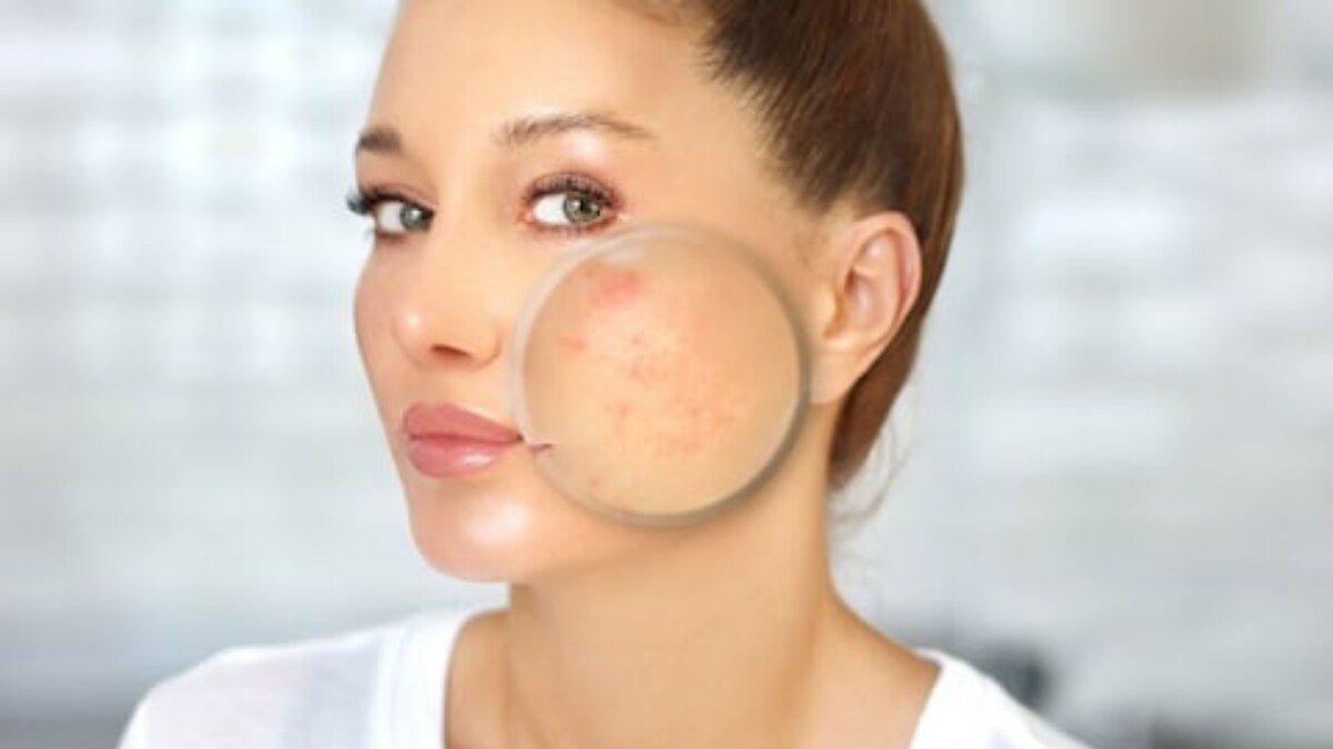 5 Home Remedies to Lighten Pokemarks On Your Face - News18