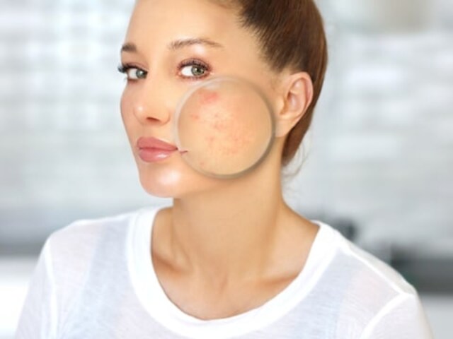 5 Home Remedies to Lighten Pokemarks On Your Face - News18