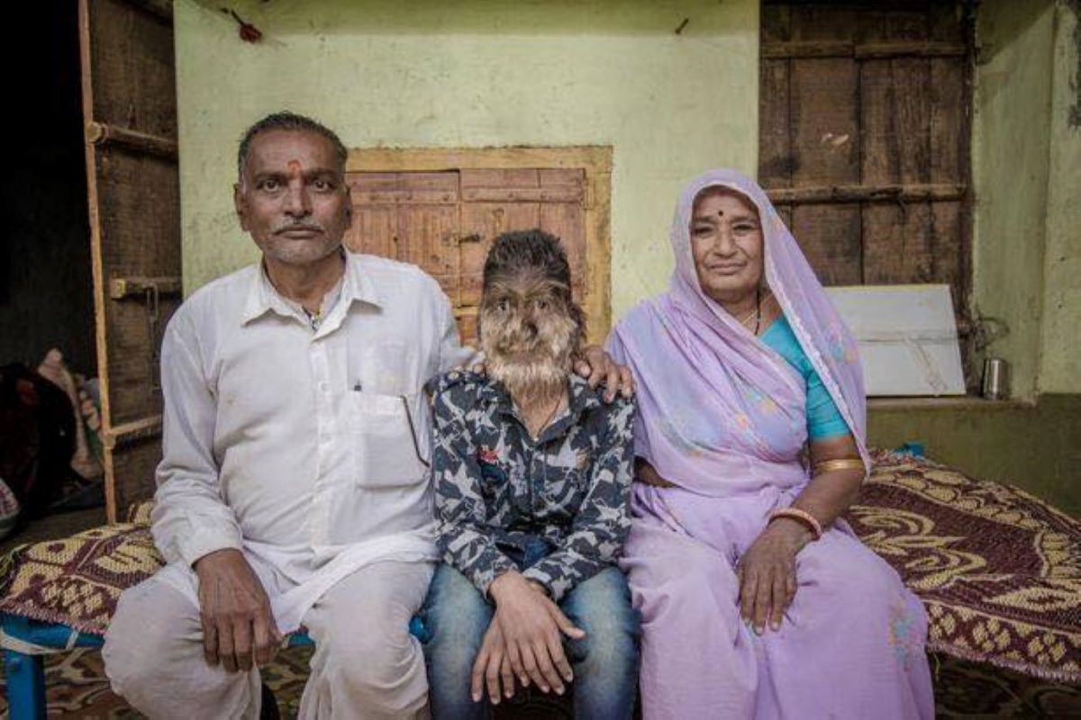 Hypertrichosis Family