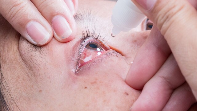 ‘Madras Eye’ Troubles Tamil Nadu as Nearly 4,000 Cases Being Reported ...