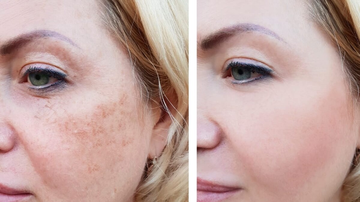 Beauty Tips: 5 Effective Home Remedies To Treat Skin Pigmentation And ...