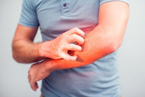 What Is COVID Arm? Symptoms, Causes And Treatment - News18