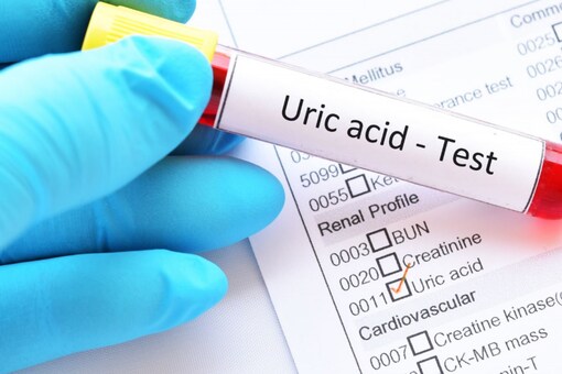 What Are The Causes of High Levels of Uric Acid in The Body? Know From ...