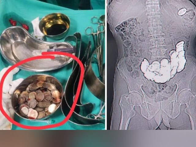 Karnataka Man Swallows 187 Coins; Bizarre Case Leaves Doctors Stunned ...