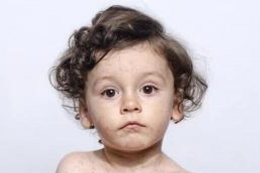 All You Need To Know About Measles And Things To Keep In Mind - News18