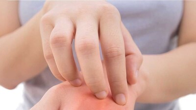 All You Need To Know About Chilblain, Symptoms And Home Remedies ...