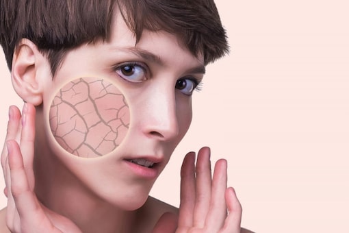 What Causes Dehydrated Skin in Winter? How To Prevent it - News18
