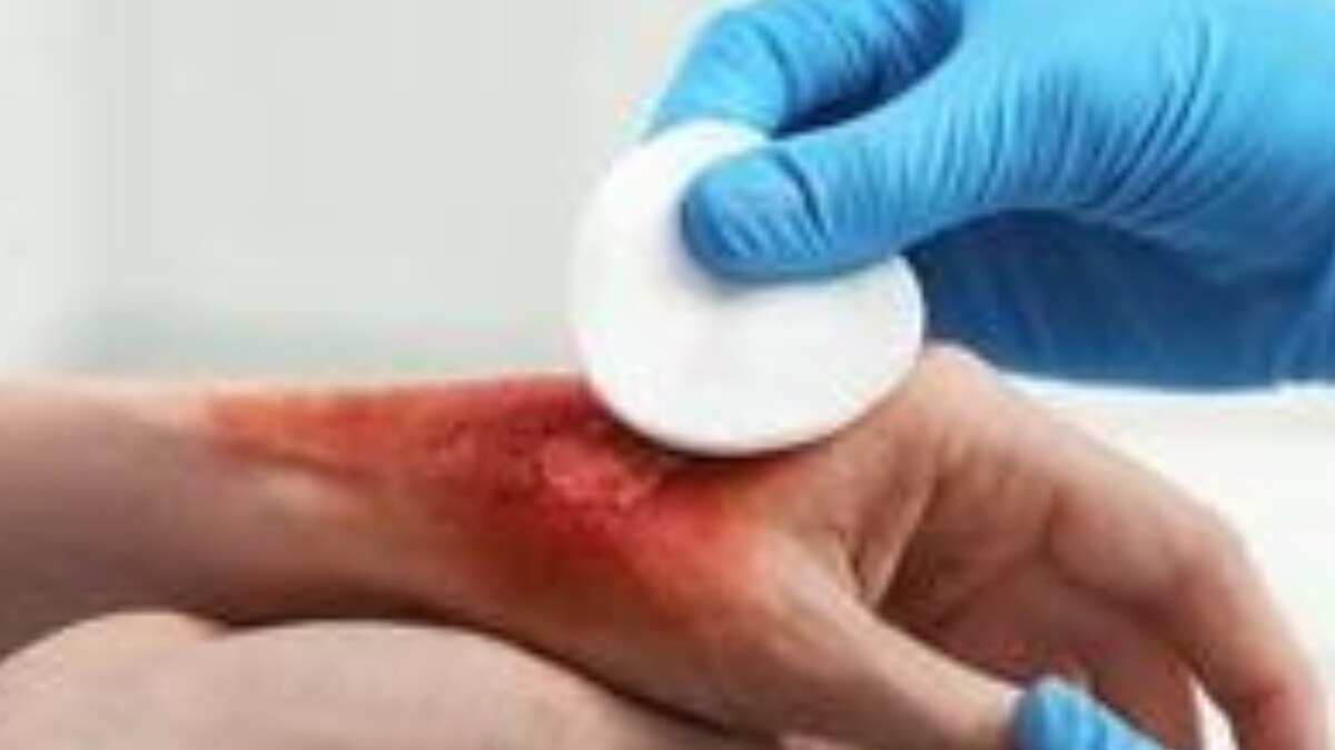 What Are Burn Injuries? Know Treatments For Patients - News18