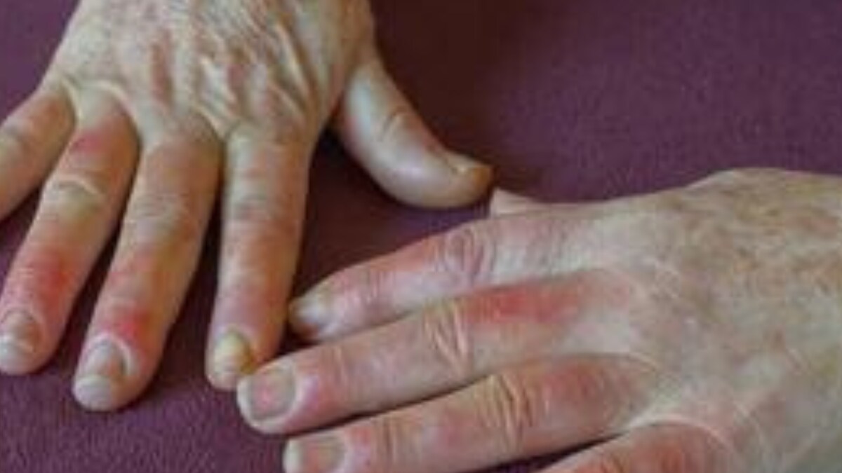 What is Raynaud’s Syndrome and How To Prevent It In Cold Conditions ...