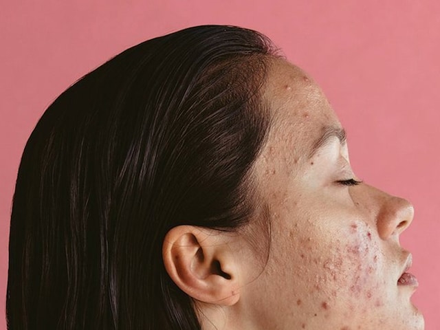 Bye, Hormonal Acne! 8 Ways To Stop Period Breakout - News18