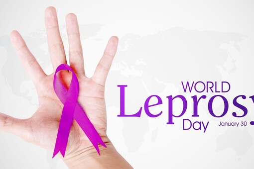 World Leprosy Day: Know More About The Condition, Symptoms, Causes And ...