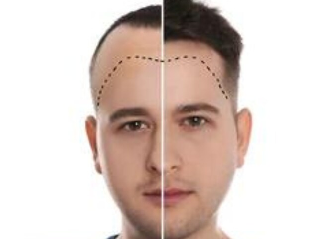 What Is A Hair Transplant Debunking 5 Myths About It News18