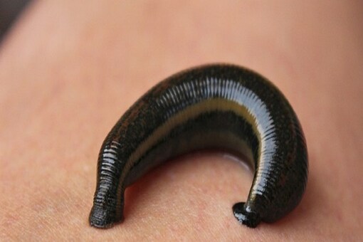 In Uttarakhand, Doctors Discover 6-Inch-Long Leech In Elderly Man's ...
