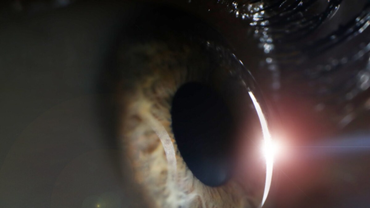 Tips to Take Care of Your Eyes Post-cataract Surgery - News18