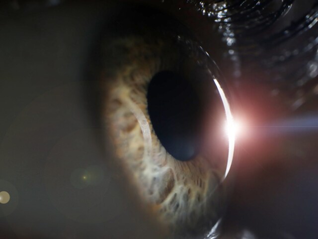Tips to Take Care of Your Eyes Post-cataract Surgery - News18