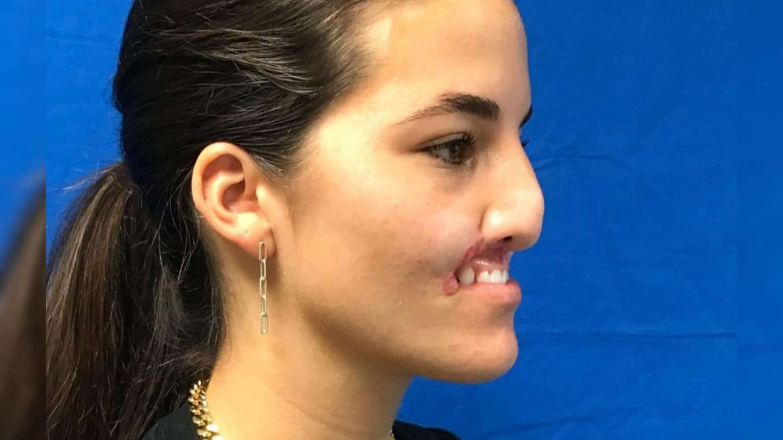Model Shares Snaps Of Her Lip Reconstruction Surgery After Pitbull ...