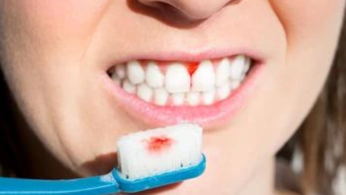 5 Oral Hygiene Practices to Avoid Bleeding Gums And Cavities - News18