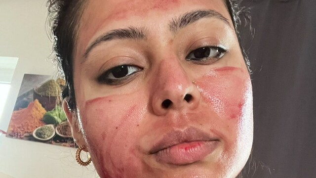 'The Ordinary Exfoliant': Woman's Prank About Using Blood For Skin Care ...